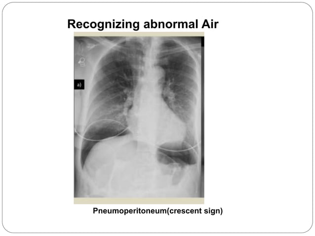 abdominal x ray radiology | PPTX