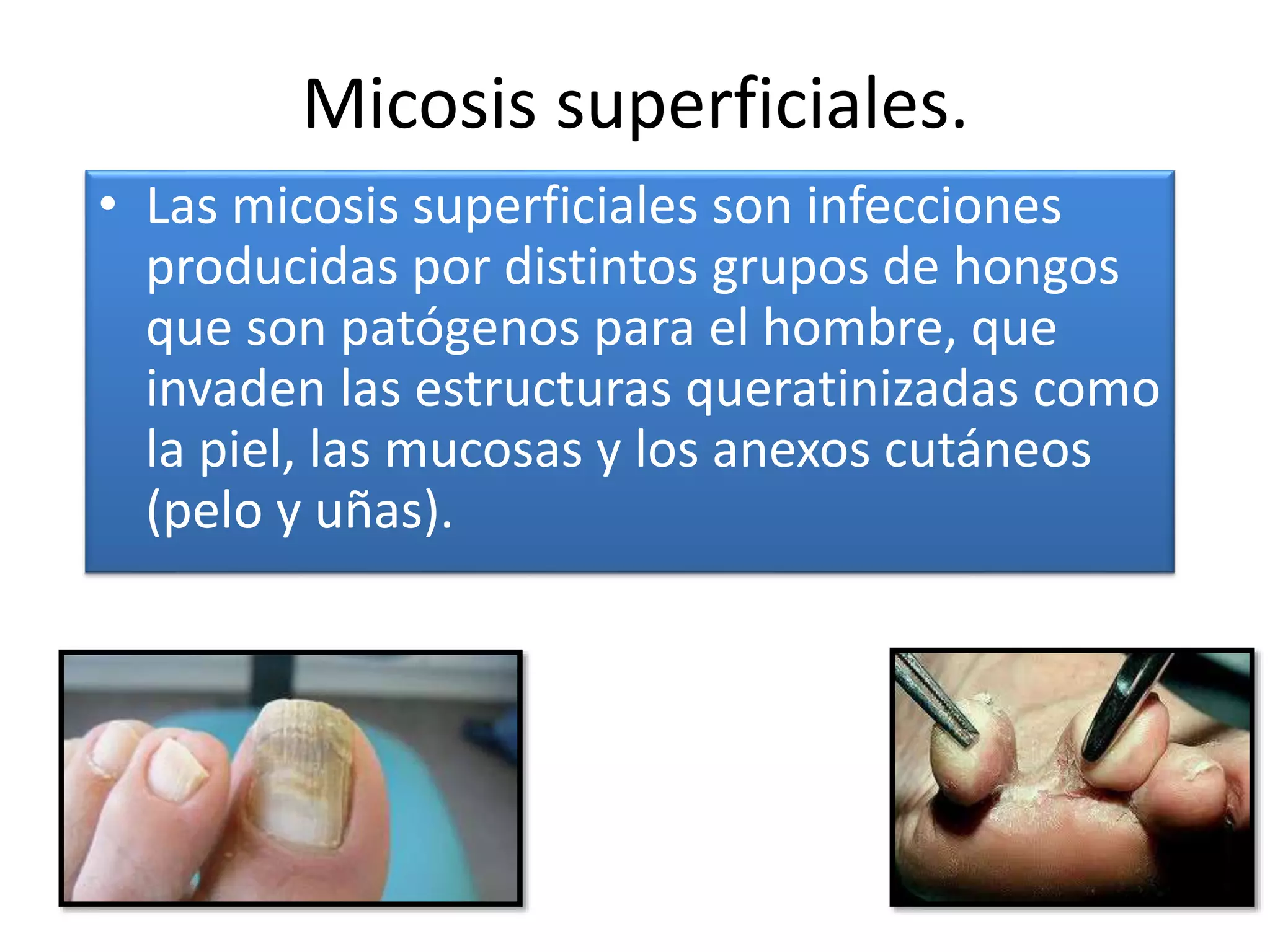 MICOSIS SUPERFICIALES | PPT