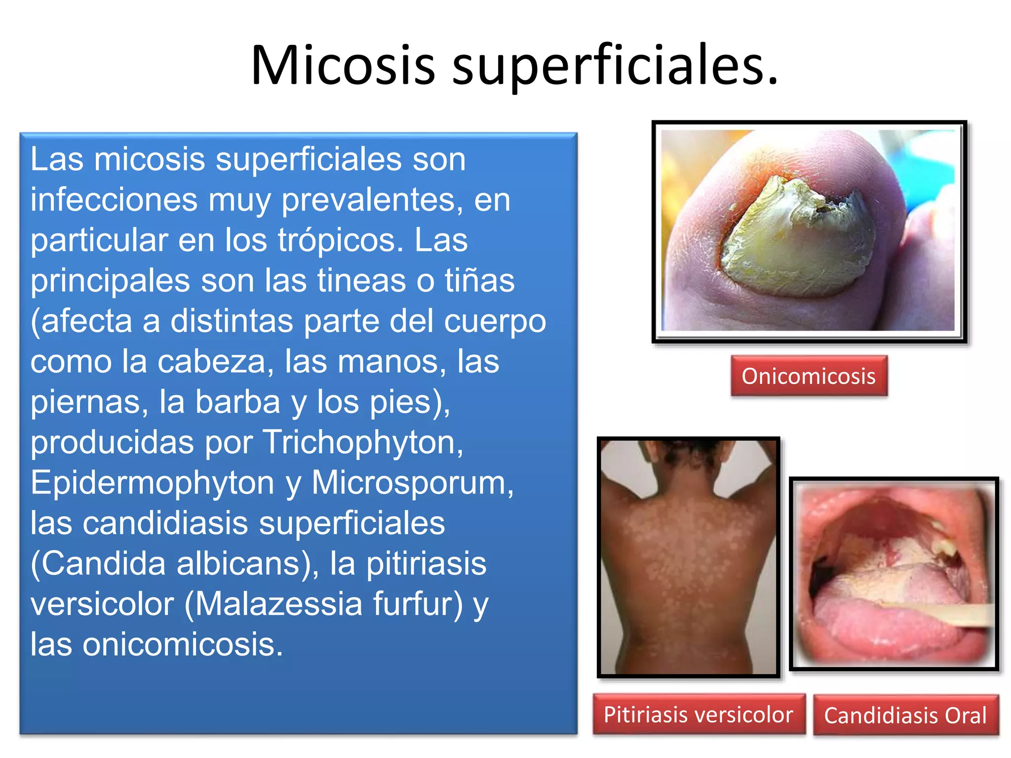 MICOSIS SUPERFICIALES | PPT