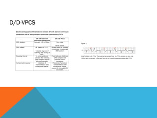 Aberrant conduction | PPT