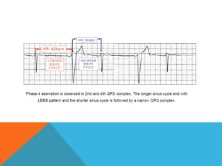 Aberrant conduction | PPT