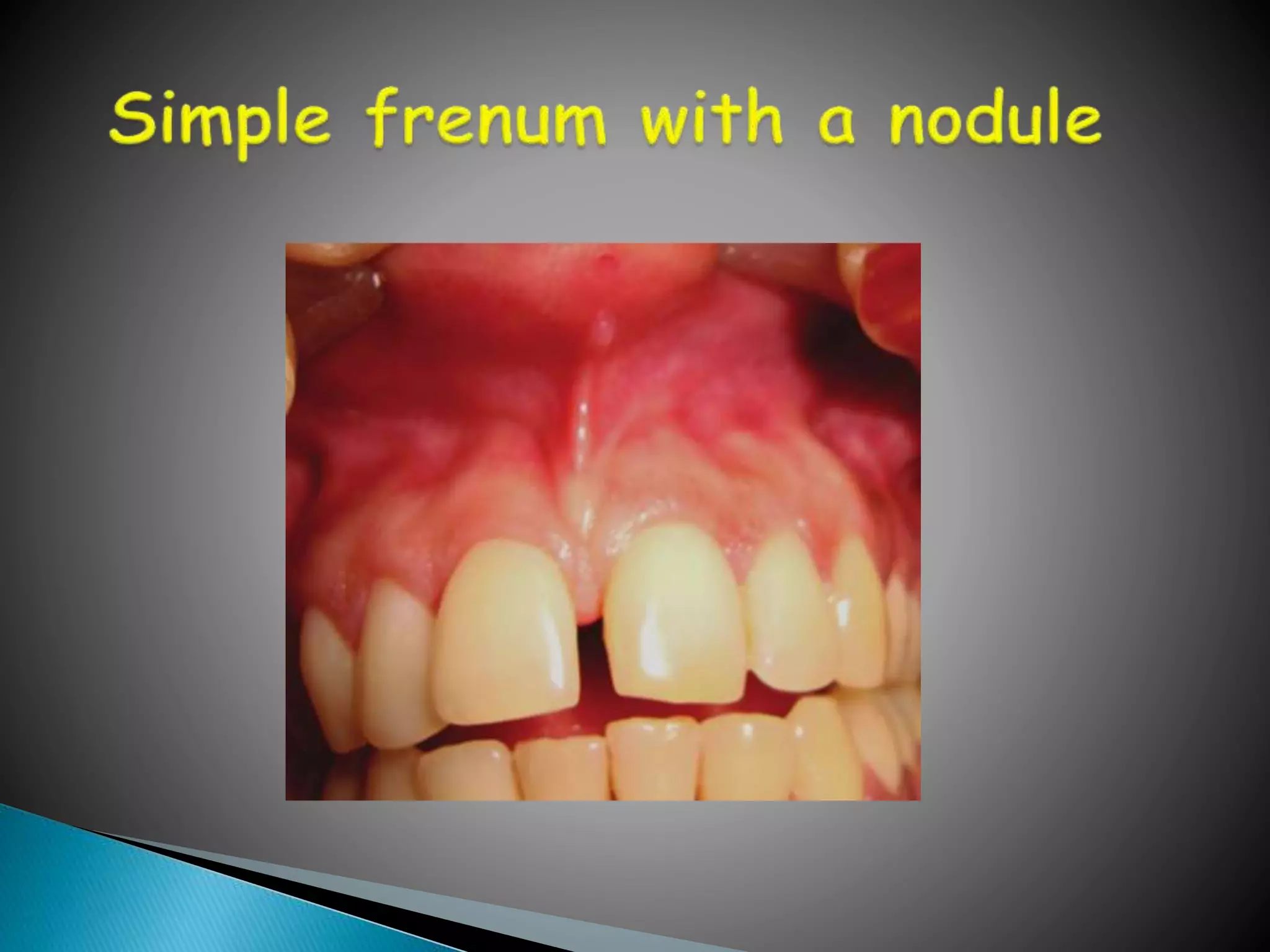 Aberrant frenum and its treatment | PPT | Free Download