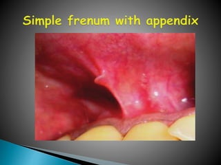Aberrant frenum and its treatment | PPTX