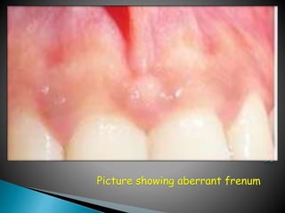 Aberrant frenum and its treatment | PPTX
