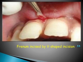 Aberrant frenum and its treatment | PPTX