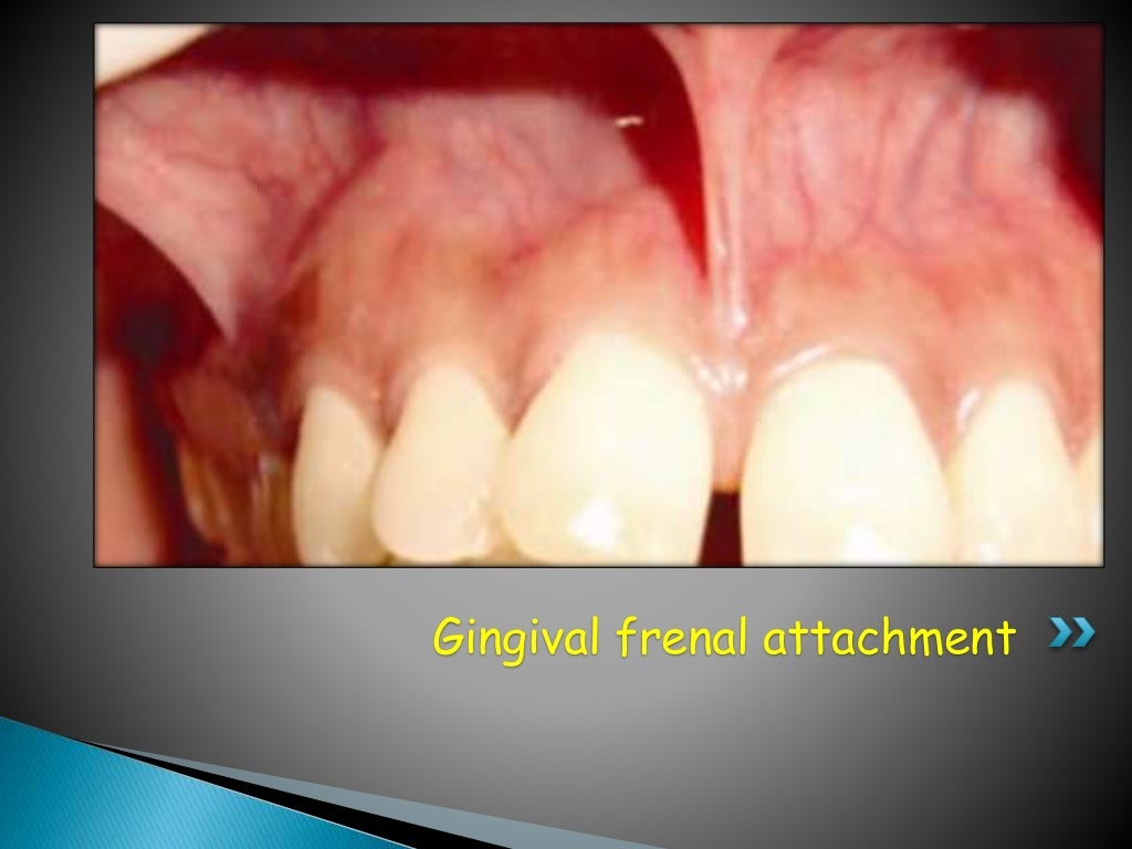 Aberrant frenum and its treatment