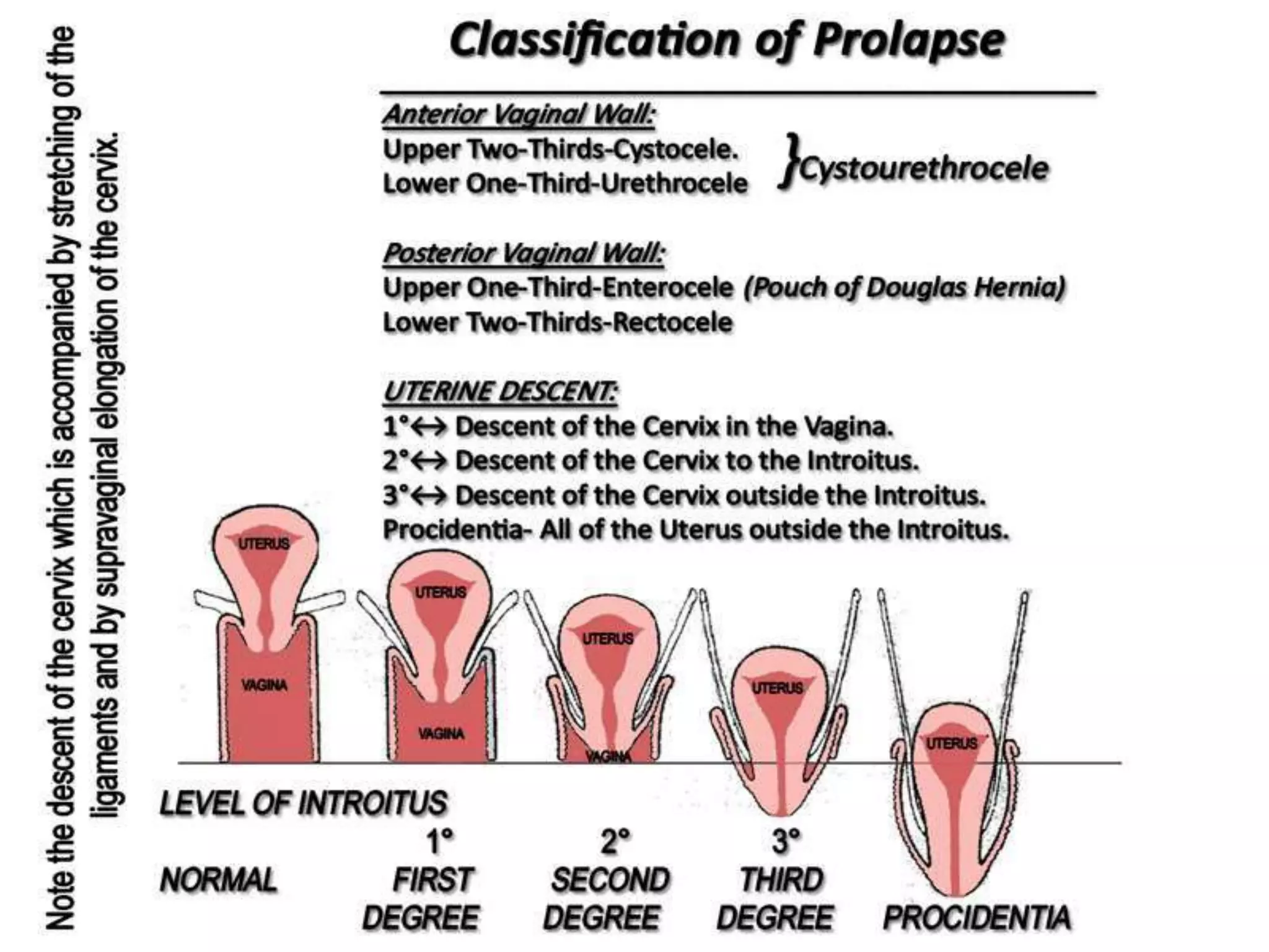 Prolapse of Uterus | PPTX