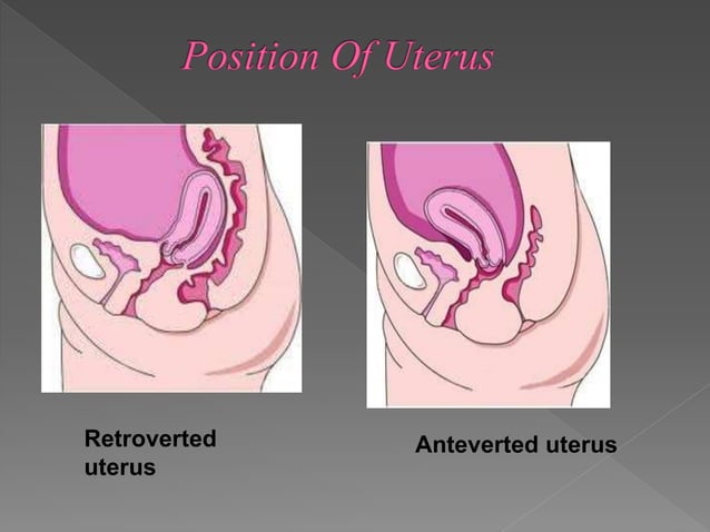 Prolapse of Uterus | PPTX