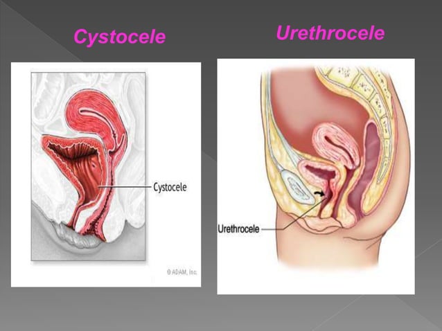 Prolapse of Uterus | PPTX