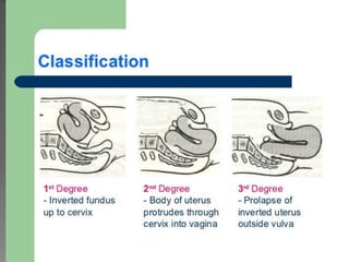 Uterine Prolapse Degrees