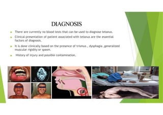 TETANUS Department of Physiotherapy, SHUATS, Prayagraj | PPTX