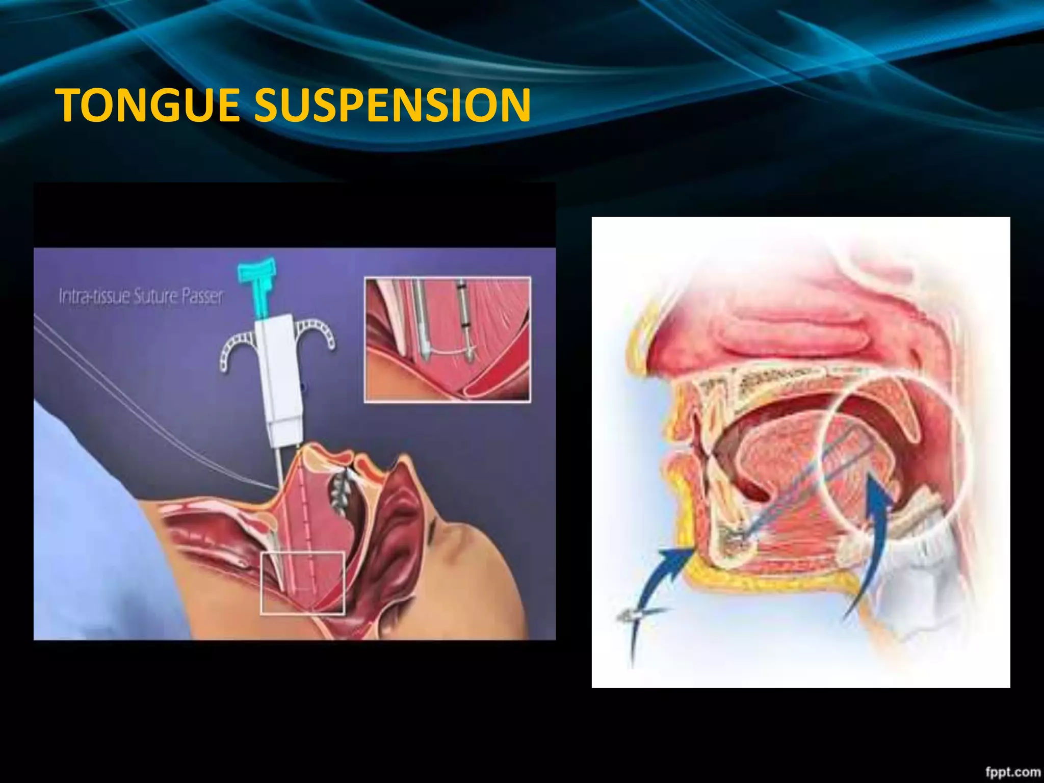 surgical management of OSA | PPTX