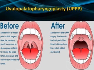 surgical management of OSA | PPTX