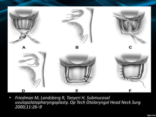 surgical management of OSA | PPTX