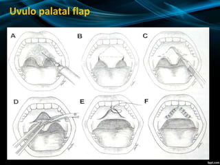 surgical management of OSA | PPTX