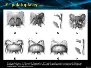 surgical management of OSA | PPTX