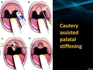 surgical management of OSA | PPTX