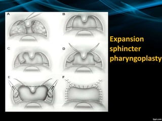 surgical management of OSA | PPTX