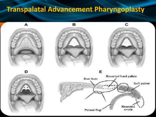 surgical management of OSA | PPTX