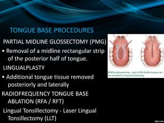 surgical management of OSA | PPTX