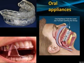 surgical management of OSA | PPTX
