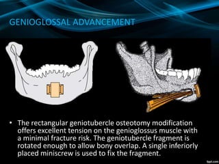 surgical management of OSA | PPTX