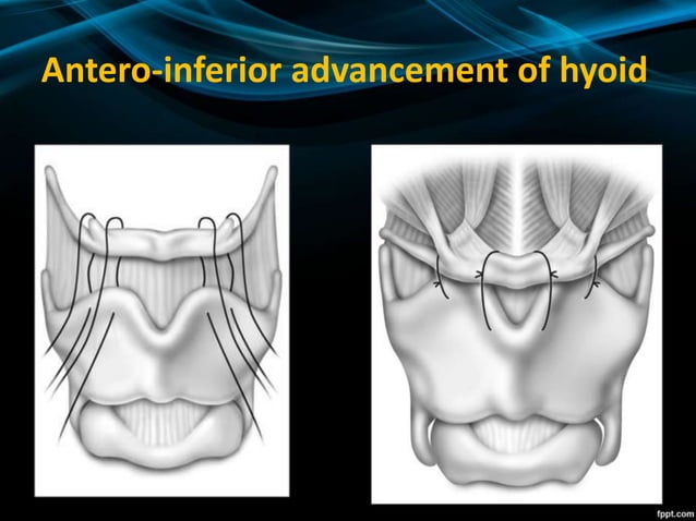 surgical management of OSA | PPTX | Ear, Nose and Throat Conditions ...