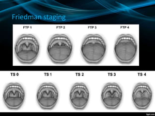 surgical management of OSA | PPTX