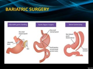 surgical management of OSA | PPTX