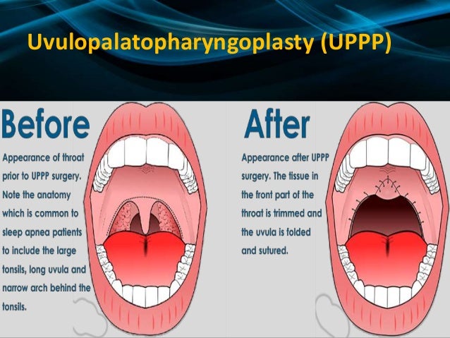 surgical management of OSA