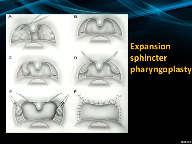 surgical management of OSA