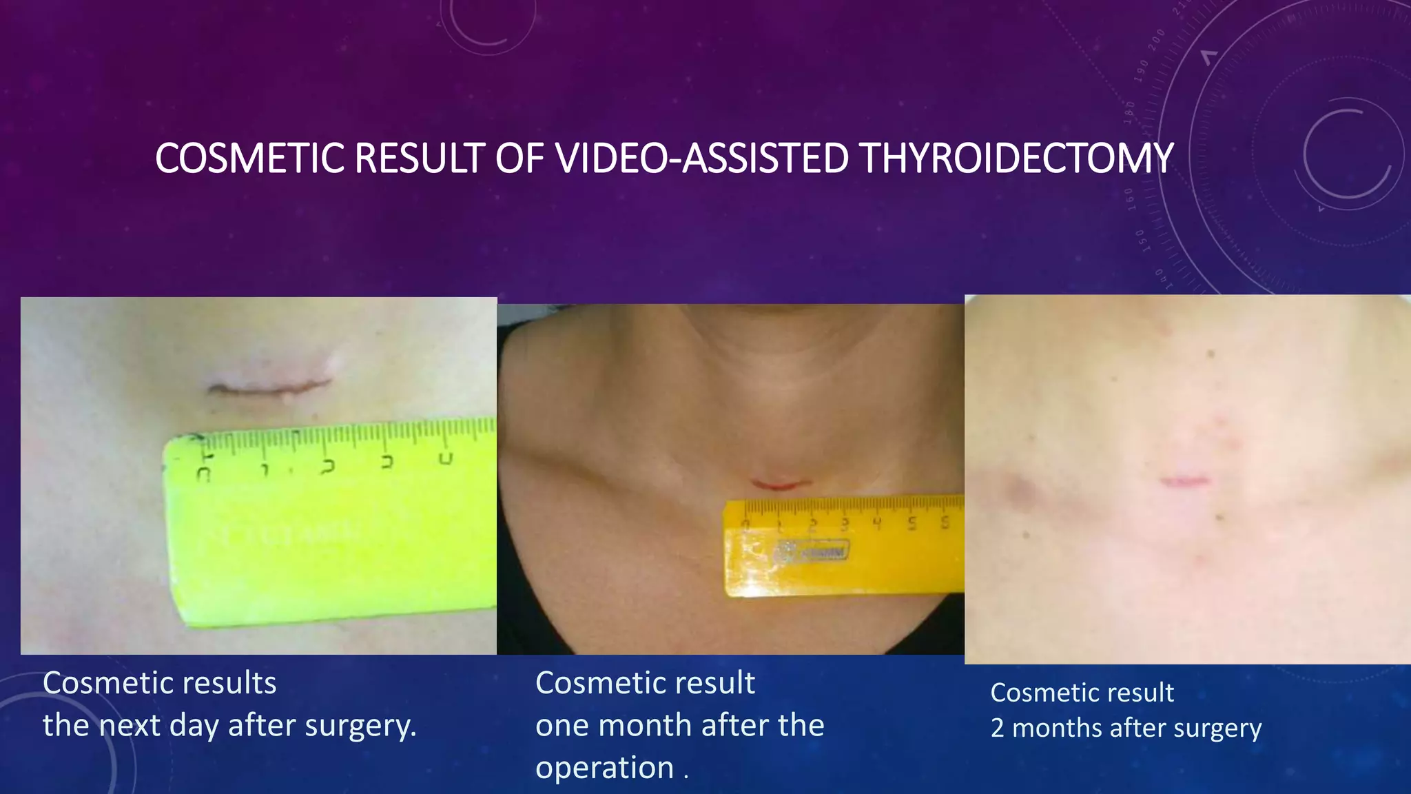 Operation in thyroid | PPTX