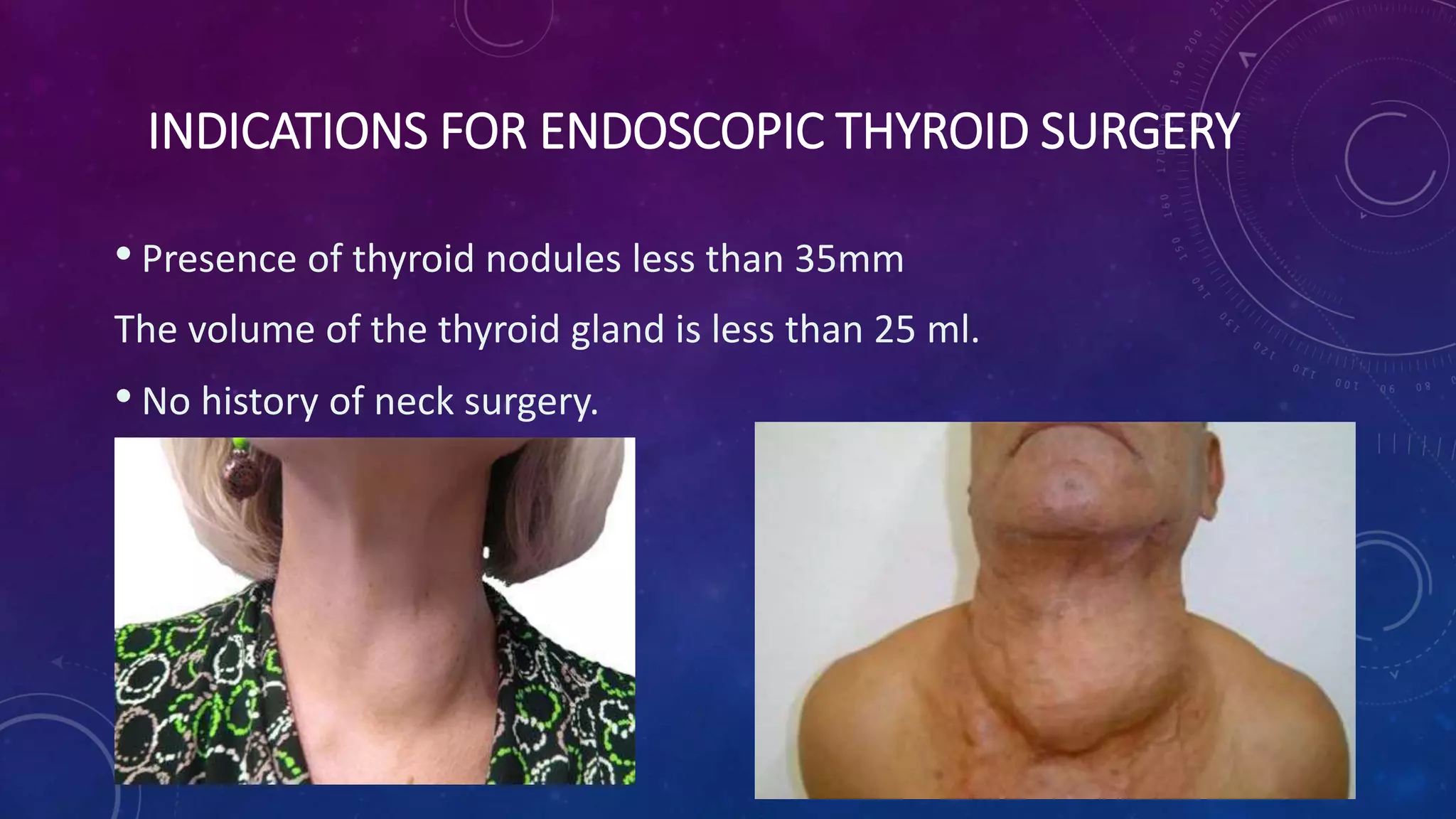Operation in thyroid | PPTX