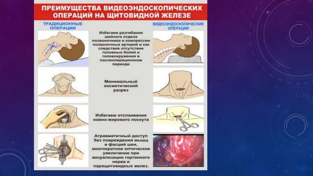 Operation in thyroid | PPTX
