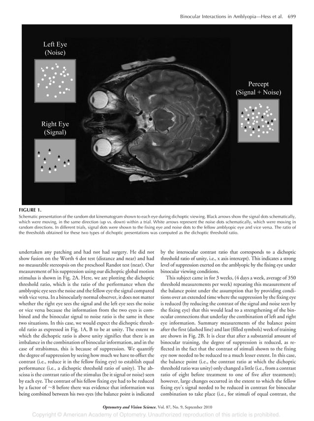 A binocular approach_to_treating_amblyopia_.11