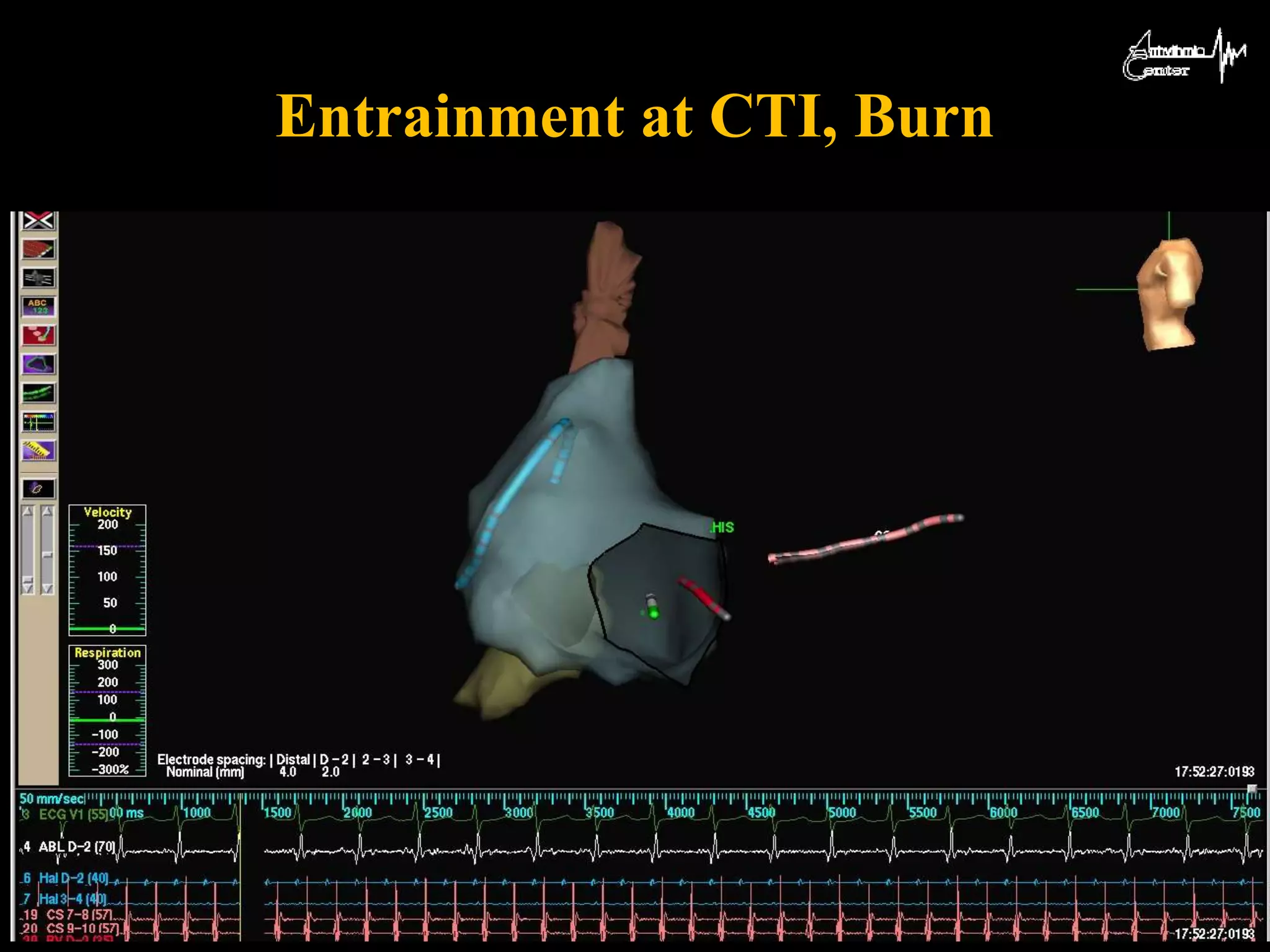 Ablation of atypical flutter | PPTX
