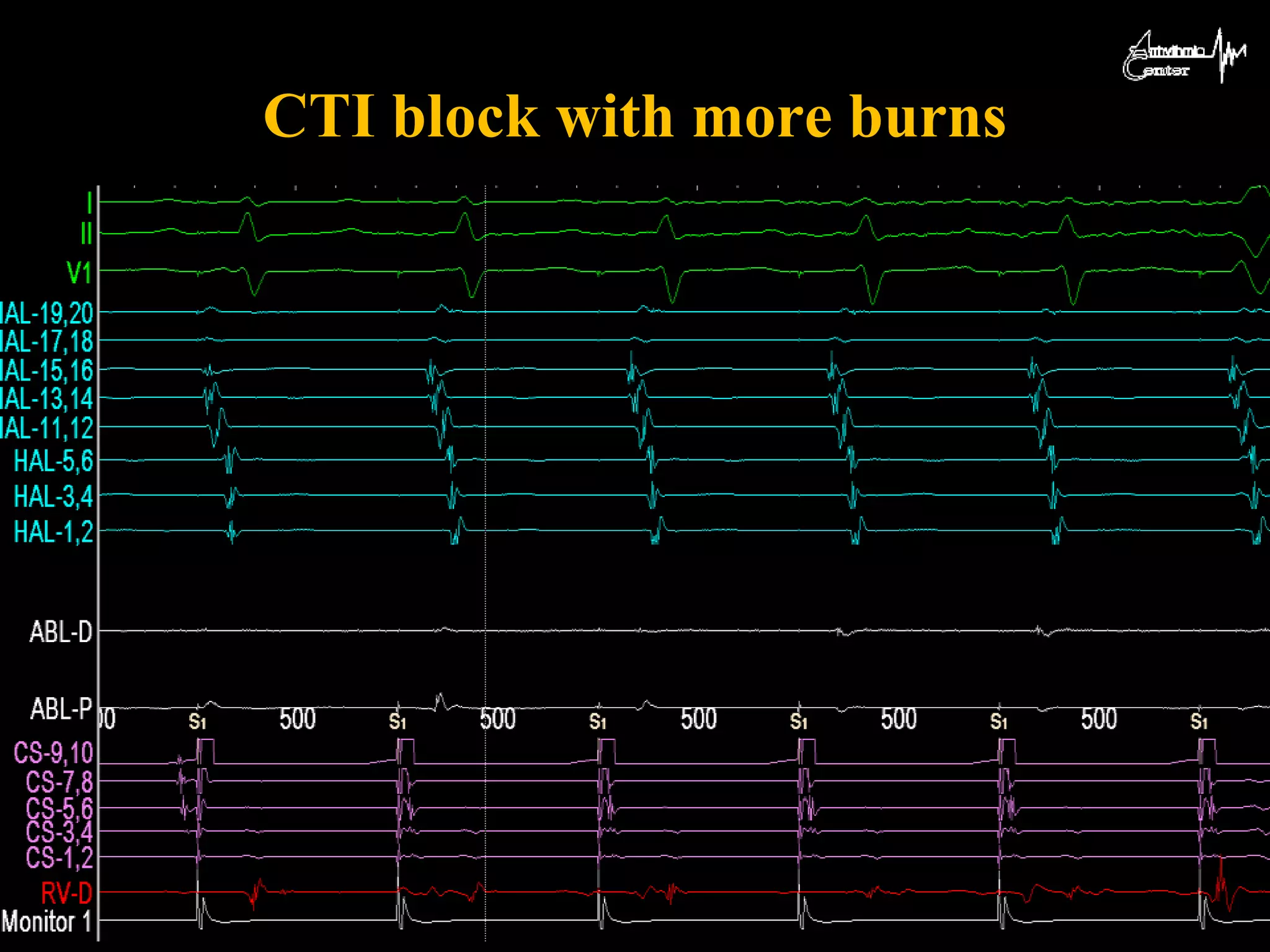 Ablation Of Atypical Flutter Pptx