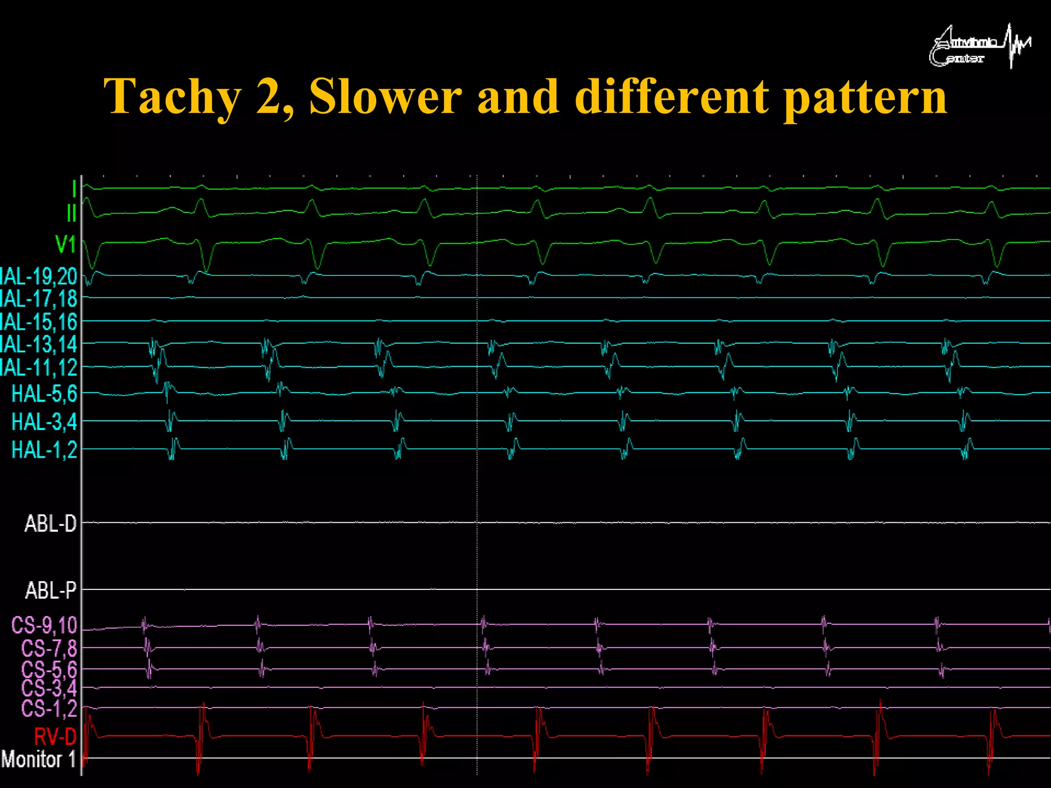 Ablation of atypical flutter | PPTX