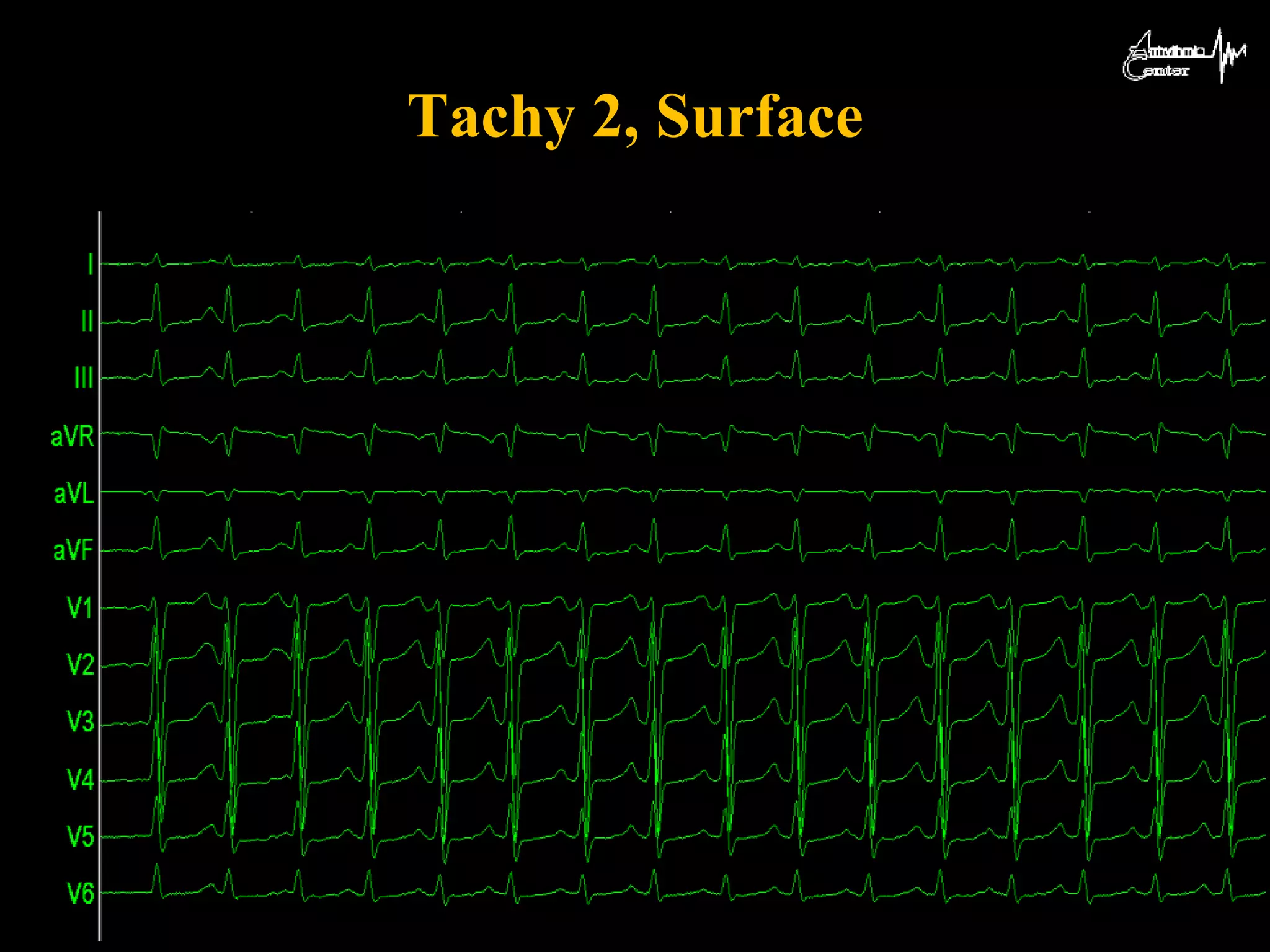 Ablation of atypical flutter | PPTX