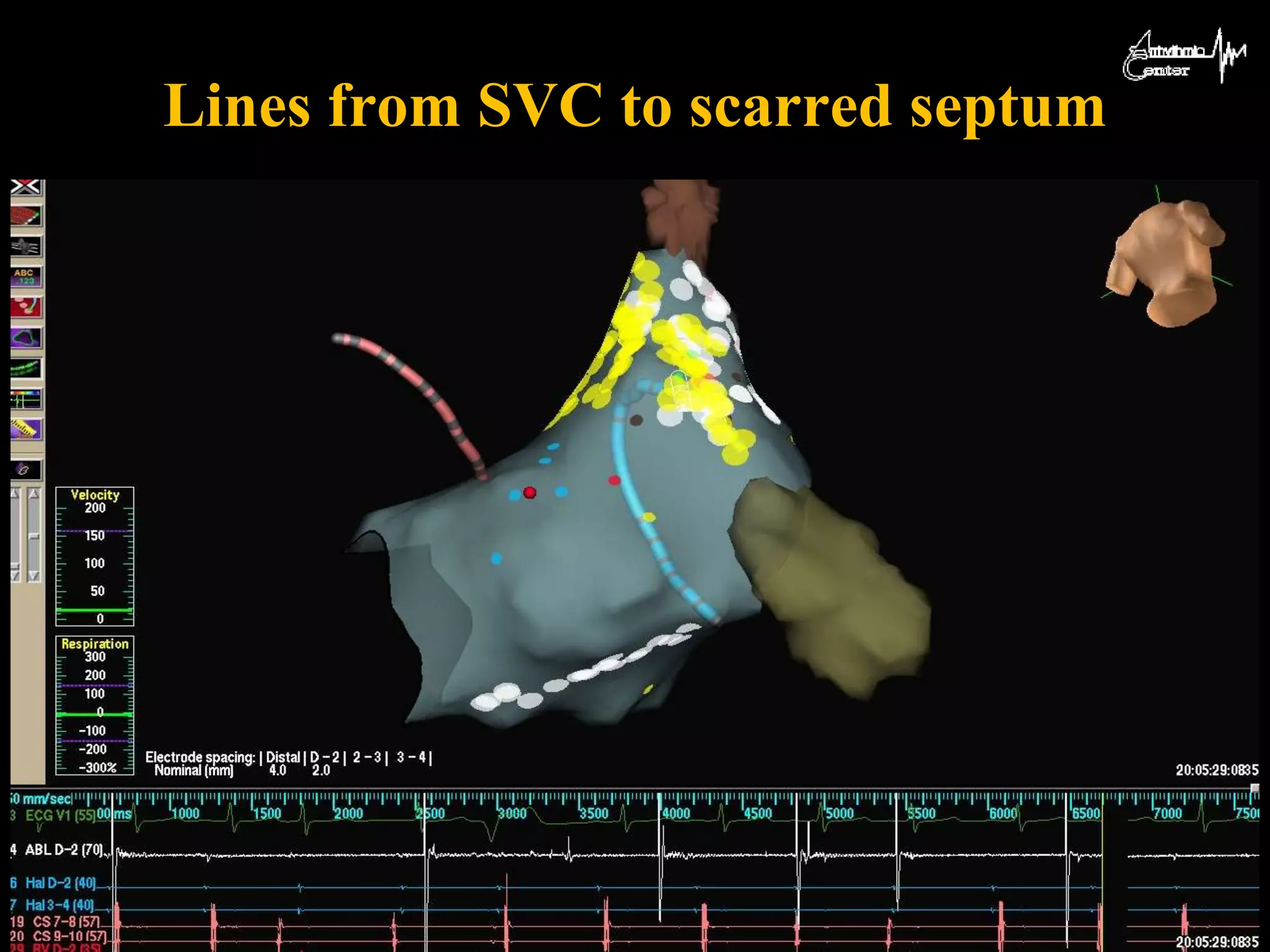 Ablation of atypical flutter | PPTX