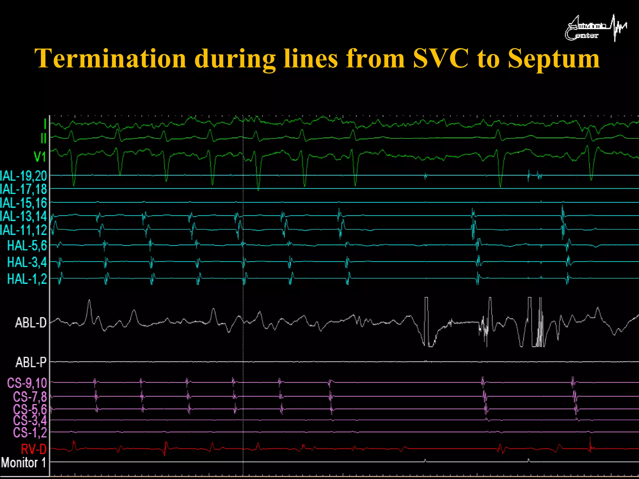 Ablation Of Atypical Flutter Pptx