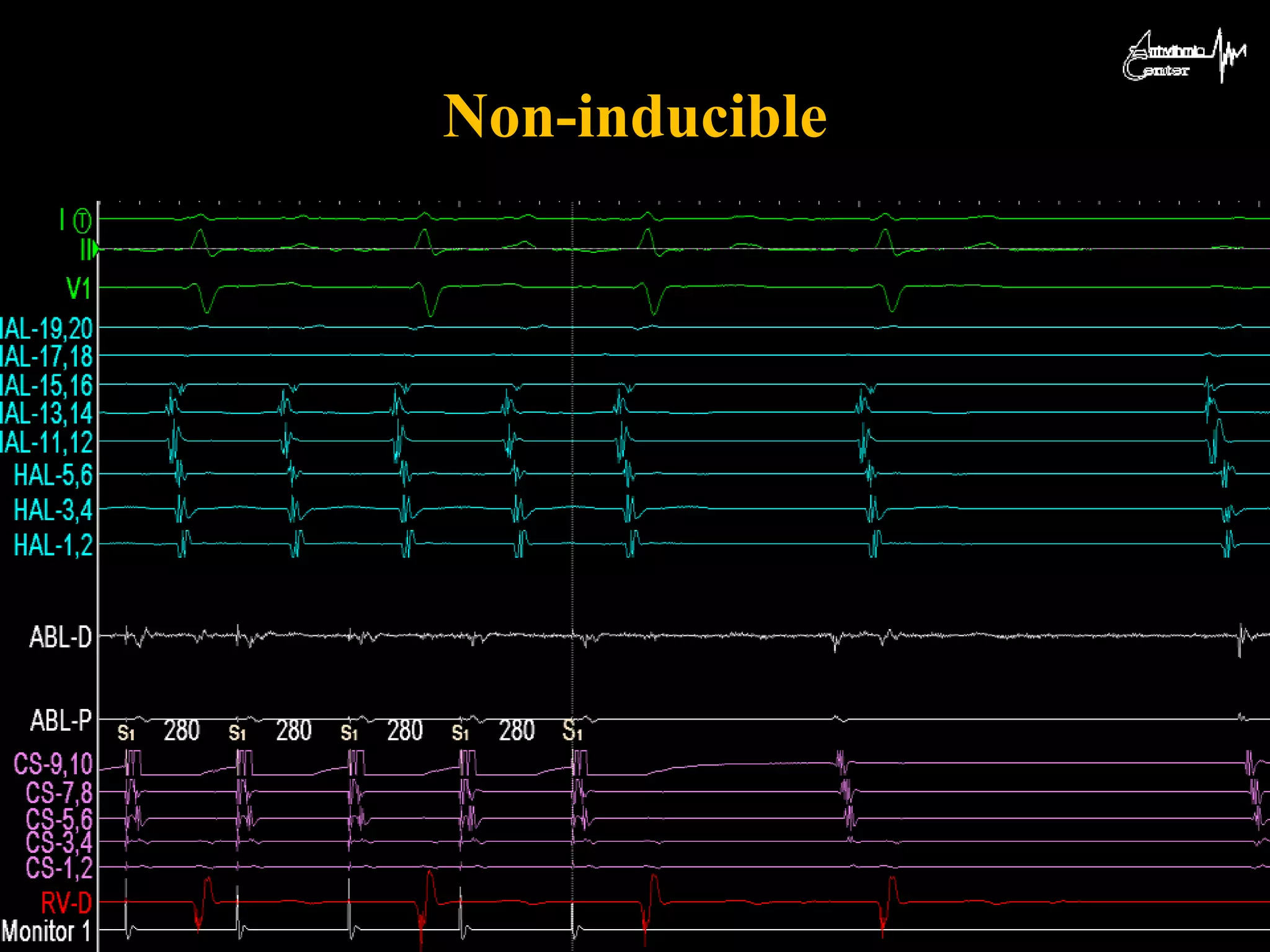 Ablation of atypical flutter | PPTX