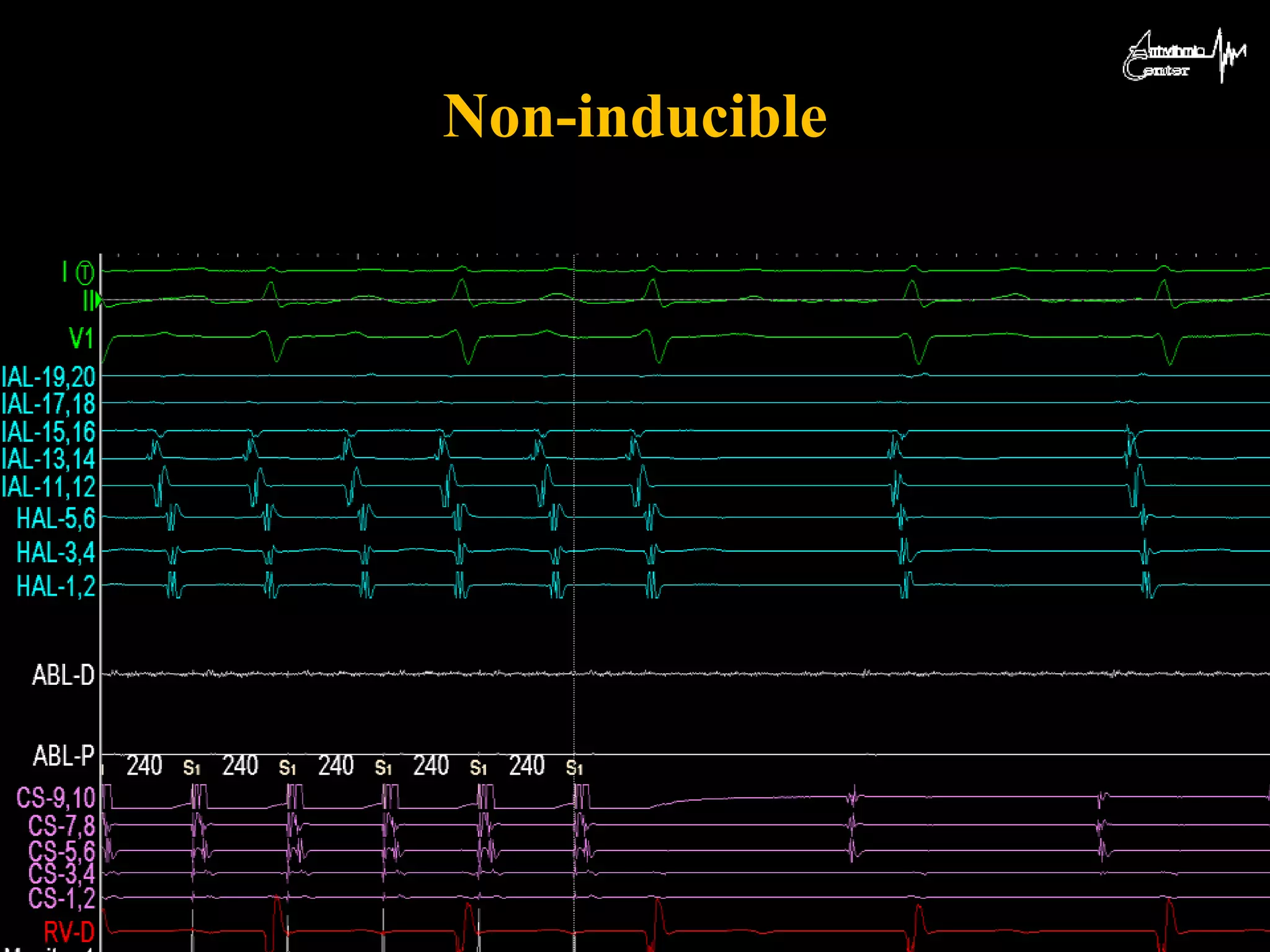 Ablation of atypical flutter | PPTX