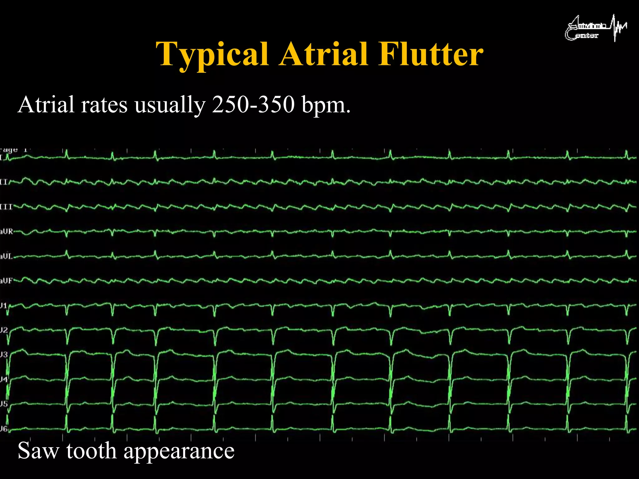 Ablation of atypical flutter | PPTX