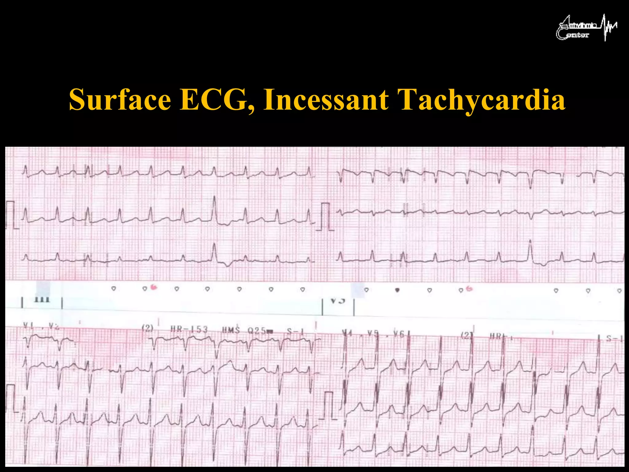 Ablation of atypical flutter | PPTX