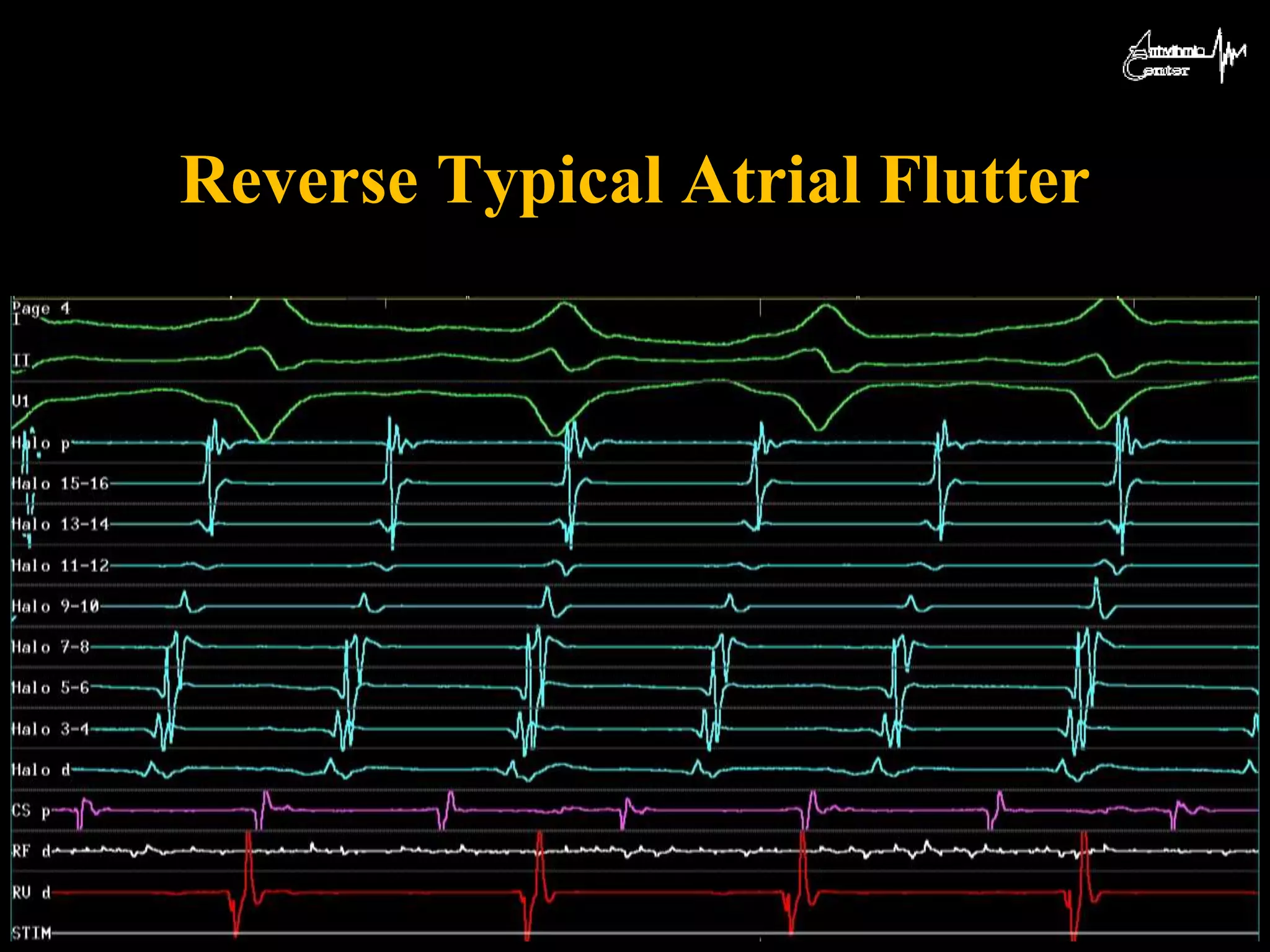 Ablation of atypical flutter | PPTX
