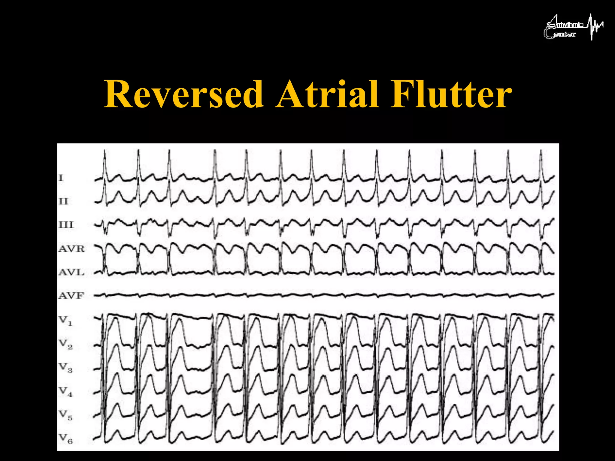 Ablation of atypical flutter | PPTX