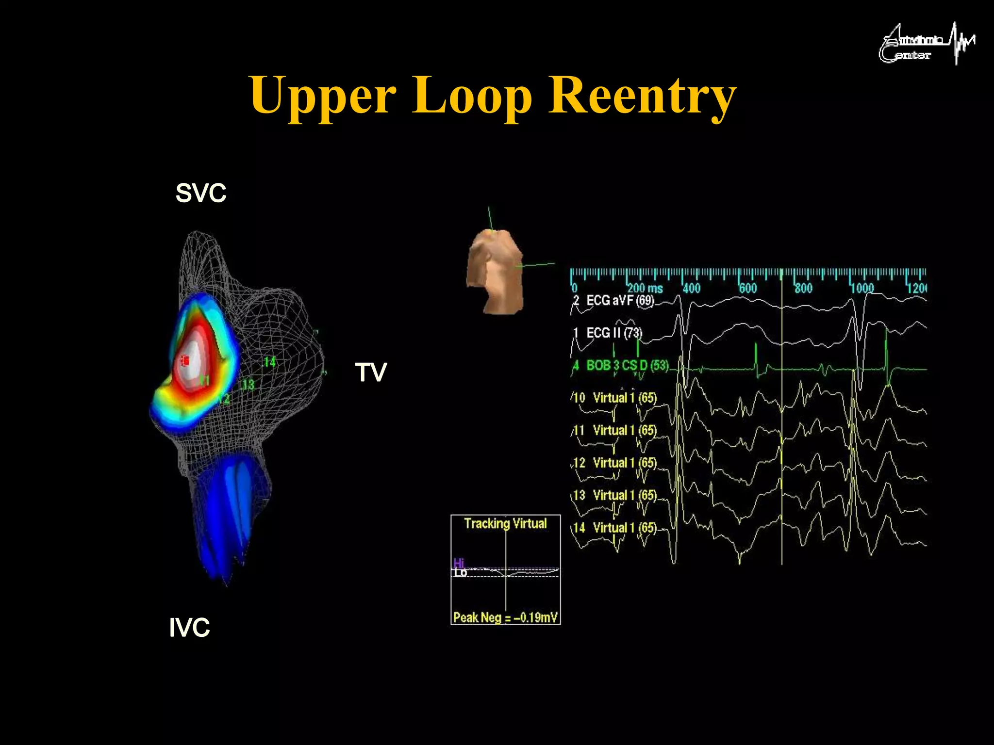 Ablation of atypical flutter | PPTX