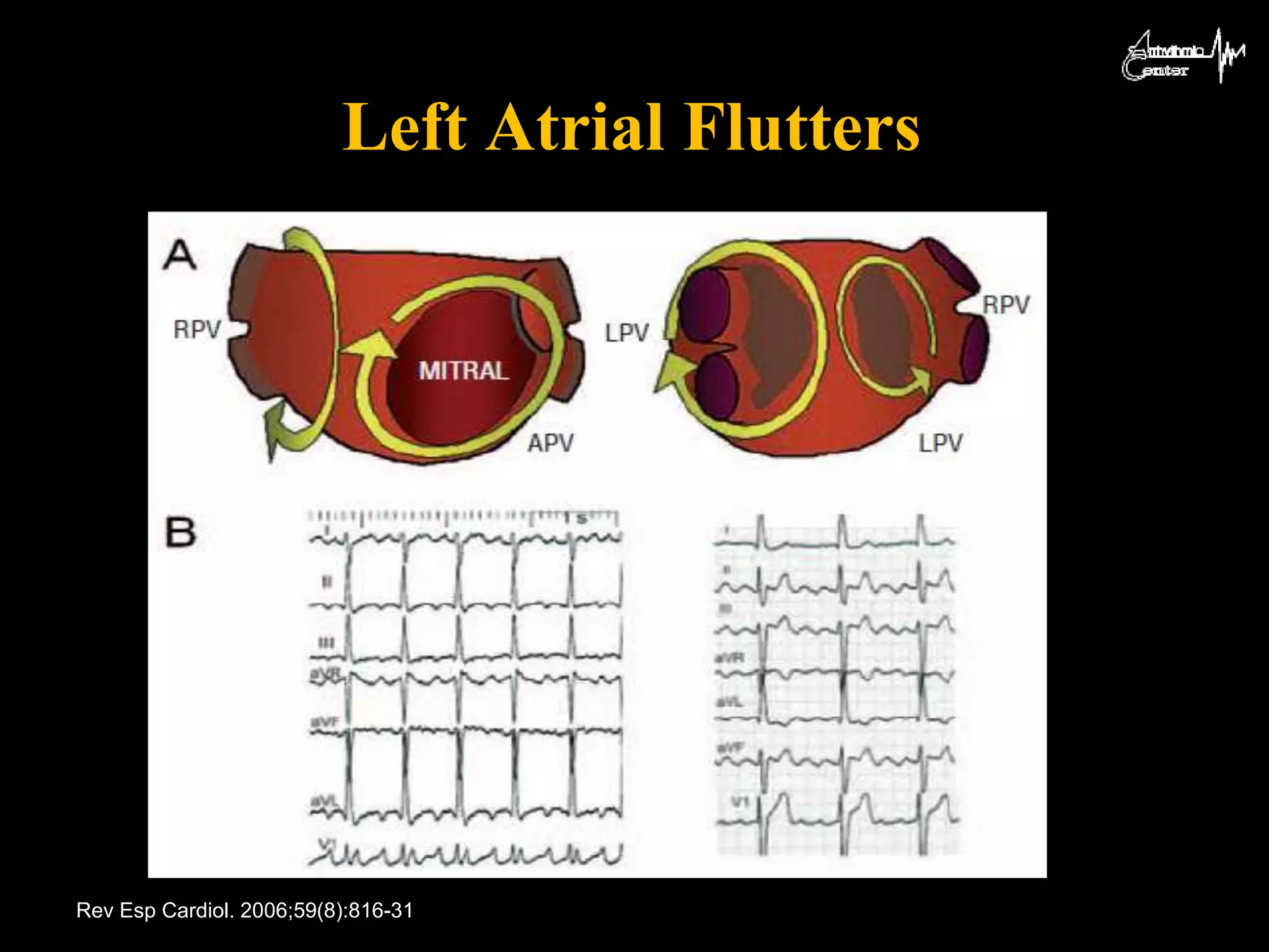 Ablation of atypical flutter | PPTX