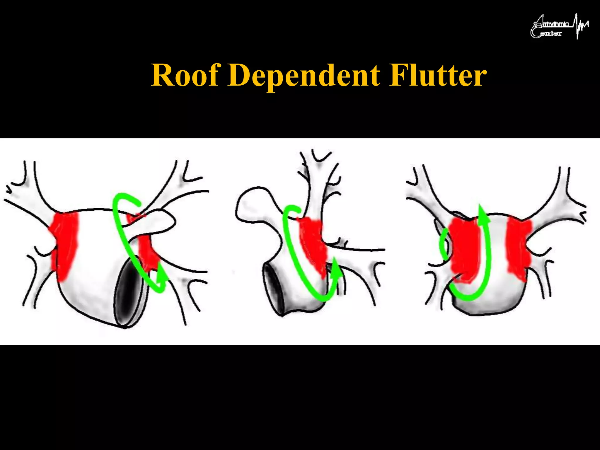 Ablation of atypical flutter | PPTX